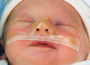 Bubble CPAP Delivery & Interface Kit,Bubble CPAP Delivery System, Over ...